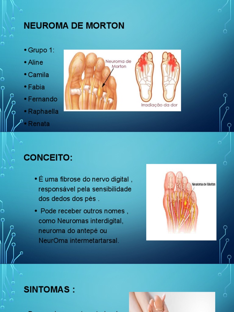 Neuroma de Morton | PDF | Ciências e Matemática