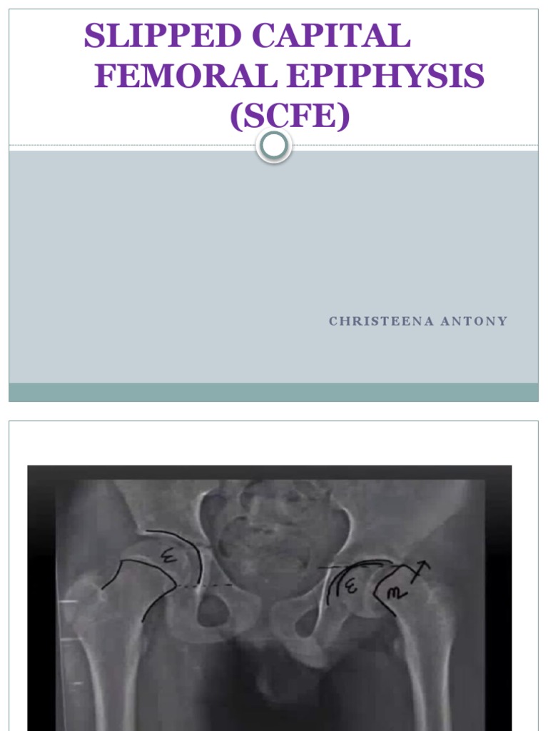 Slipped Capital Femoral Epiphysis (Scfe) | PDF | Clinical Medicine ...