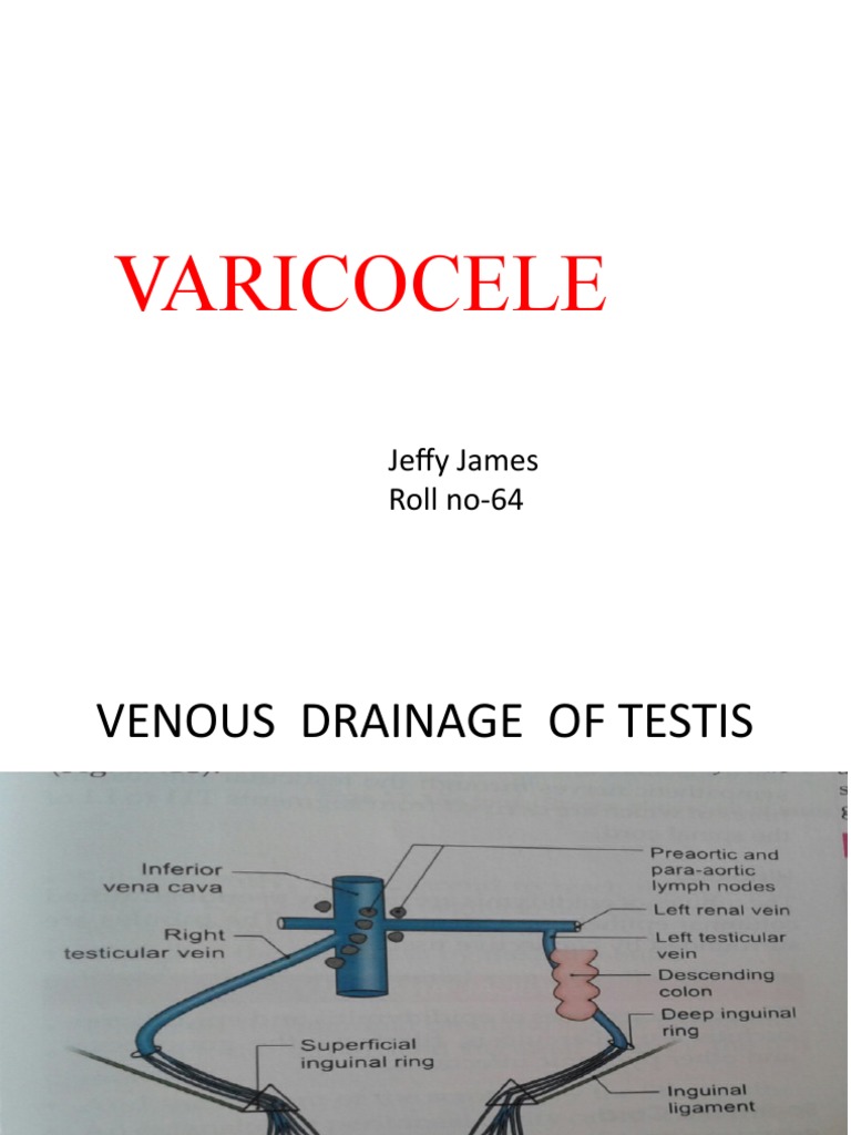 Varicocele | Download Free PDF | Vein | Testicle