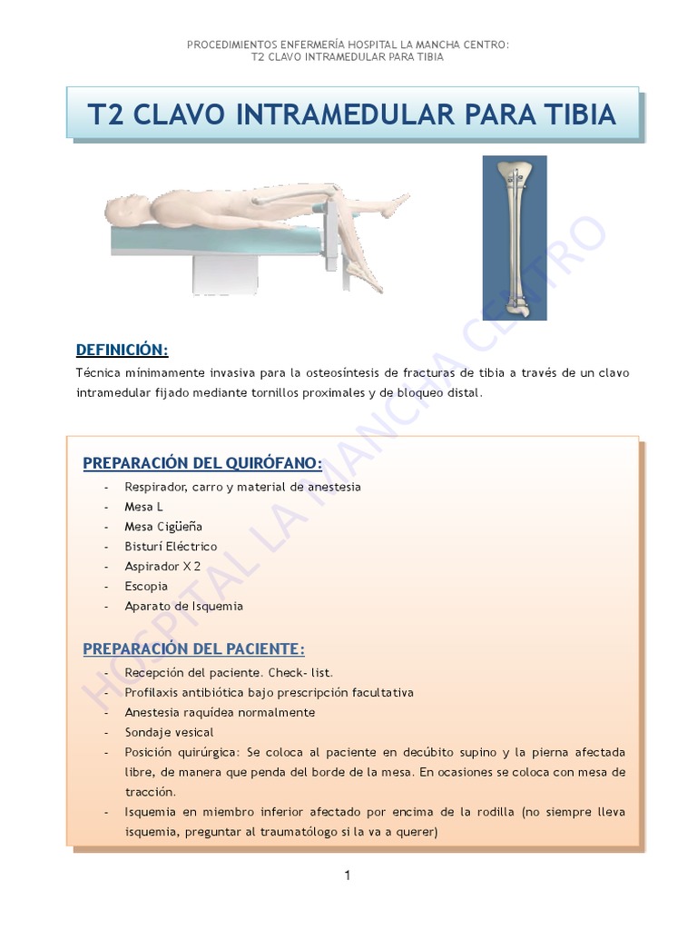 Clavo T2 Tibia | PDF | Tornillo | Rodilla
