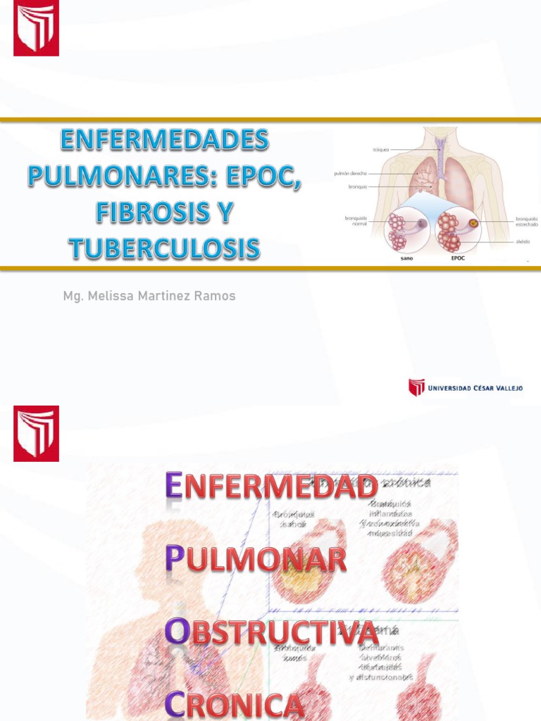 12-30-2020 180929 PM Presentación 13 | PDF | Tuberculosis | Tos