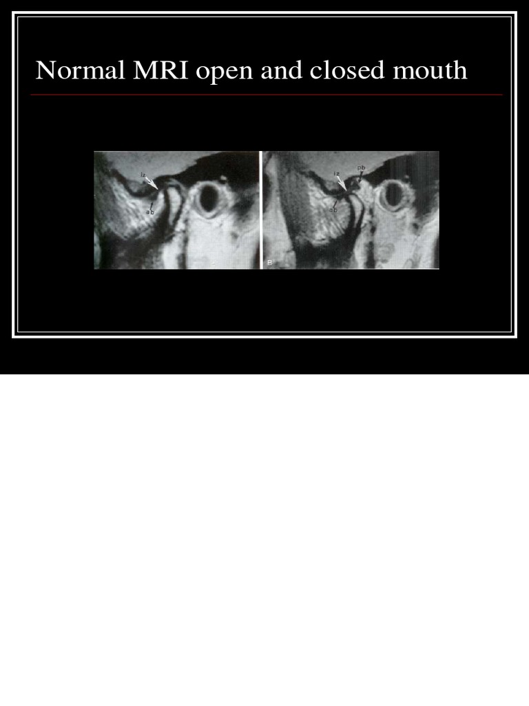 Normal and Abnormal TMJ MRI Findings | PDF | Musculoskeletal System ...