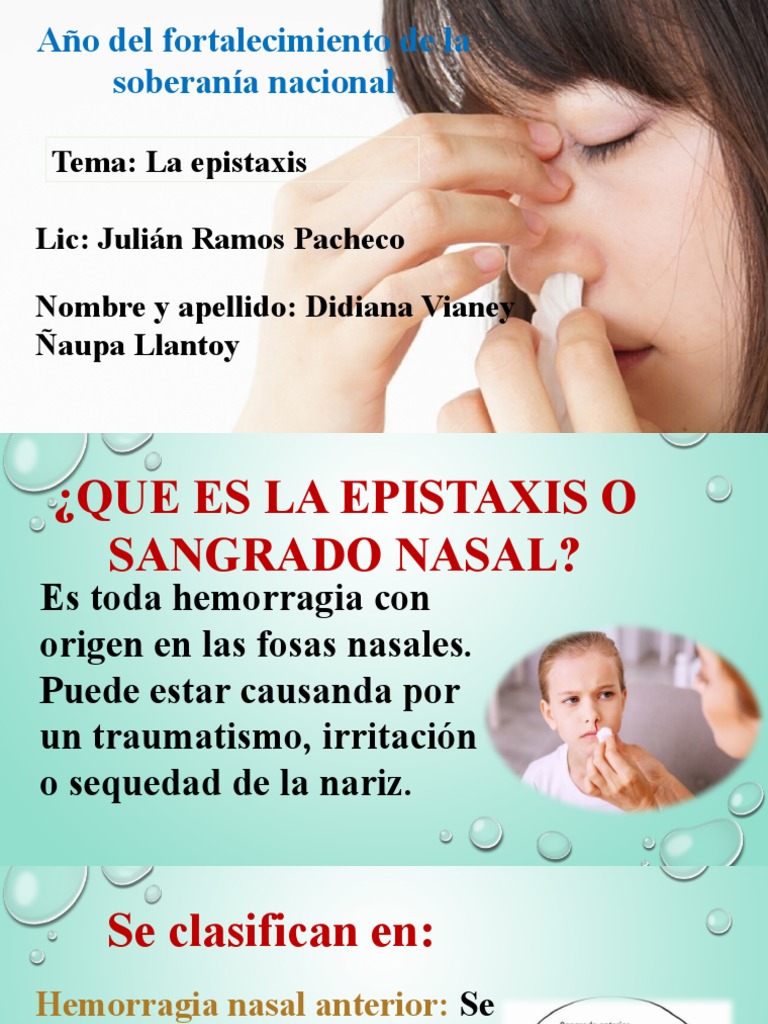 LA EPISTAXIS.pptx | PDF
