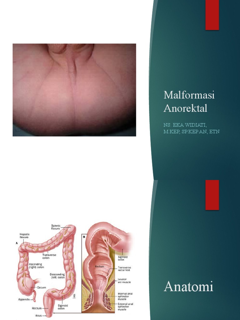Malformasi Anorektal | PDF
