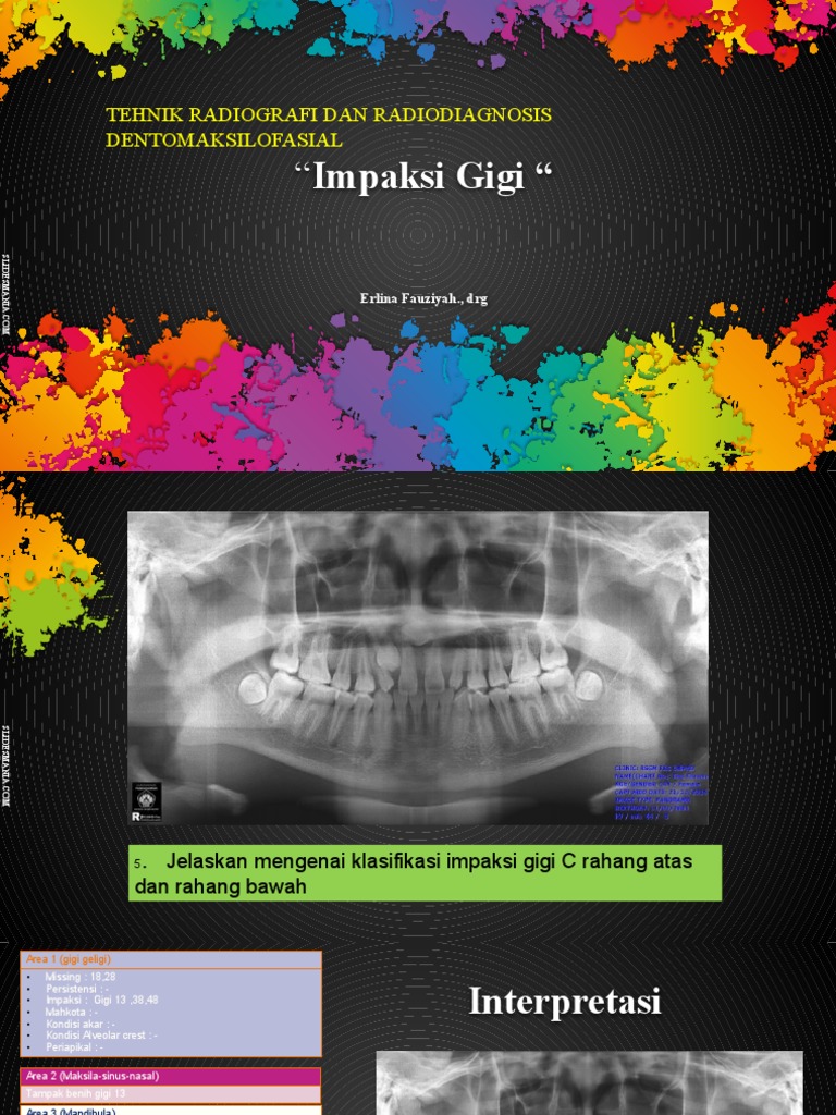 KLASIFIKASI IMPAKSI GIGI DAN INTERPRETASI PADA RADIOGRAFI | PDF