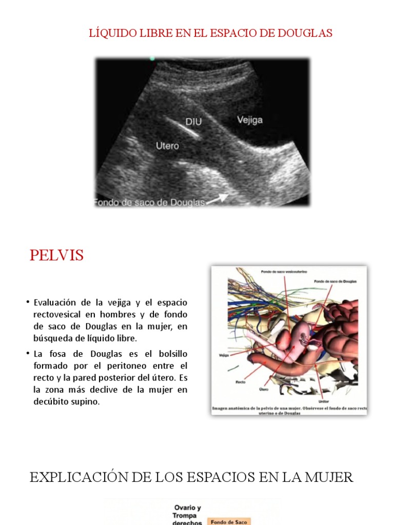 Líquido Libre en El Espacio de Douglas | PDF
