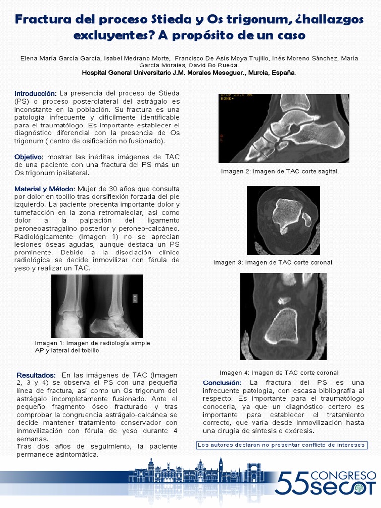 Fractura del Proceso de Stieda y Os Trigonum | PDF | Ct Scan | Causas ...