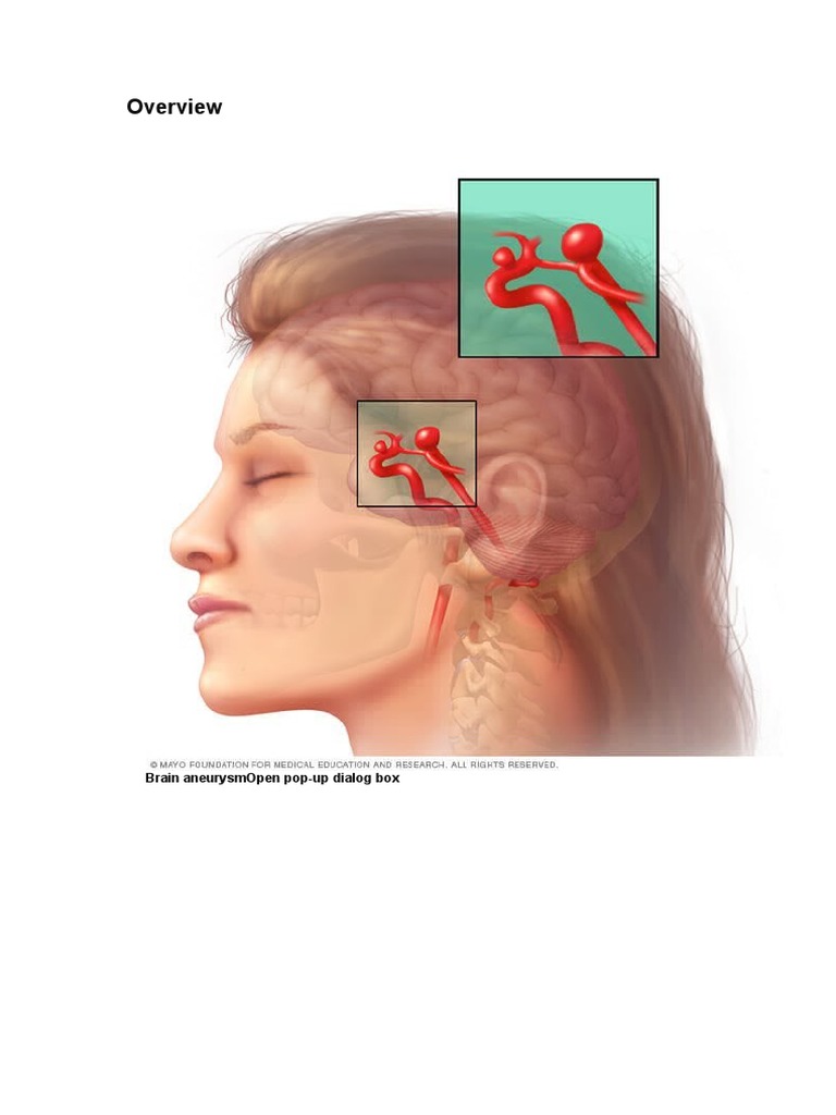 Aneurysm | PDF | Headache | Human Diseases And Disorders