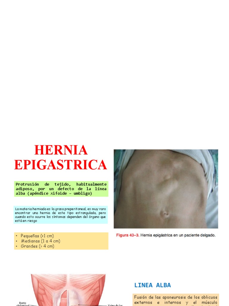 Hernia Epigastrica | Descargar gratis PDF | Abdomen | Causas de la muerte