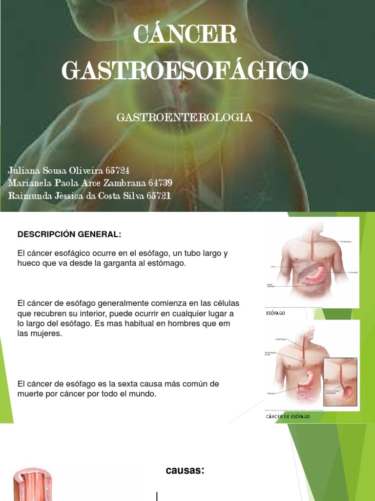 Cáncer Esofágico: Guía Completa | PDF | Cáncer de esófago | Cáncer