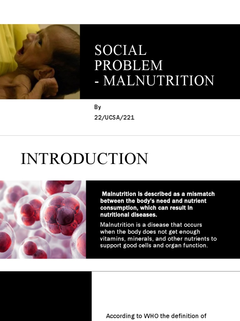 Malnutrition | PDF | Malnutrition | Nutrients