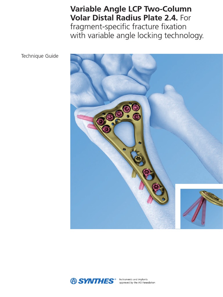 VA LCP Two Column Distal Radius Plate 2.4mm PDF | PDF | Musculoskeletal ... VA LCP Two Column Distal Radius Plate 2.4mm PDF | PDF | Musculoskeletal ...