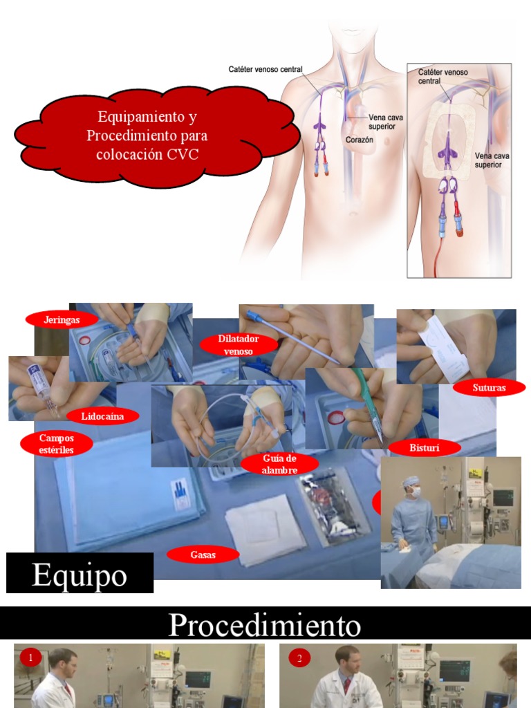 Procedimiento y equipo para CVC | PDF