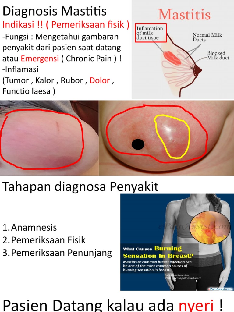 Diagnosa Mastitis | PDF