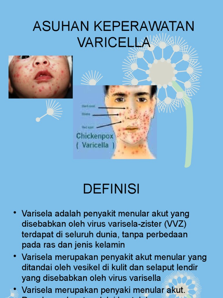 Asuhan Keperawatan Varicella | PDF