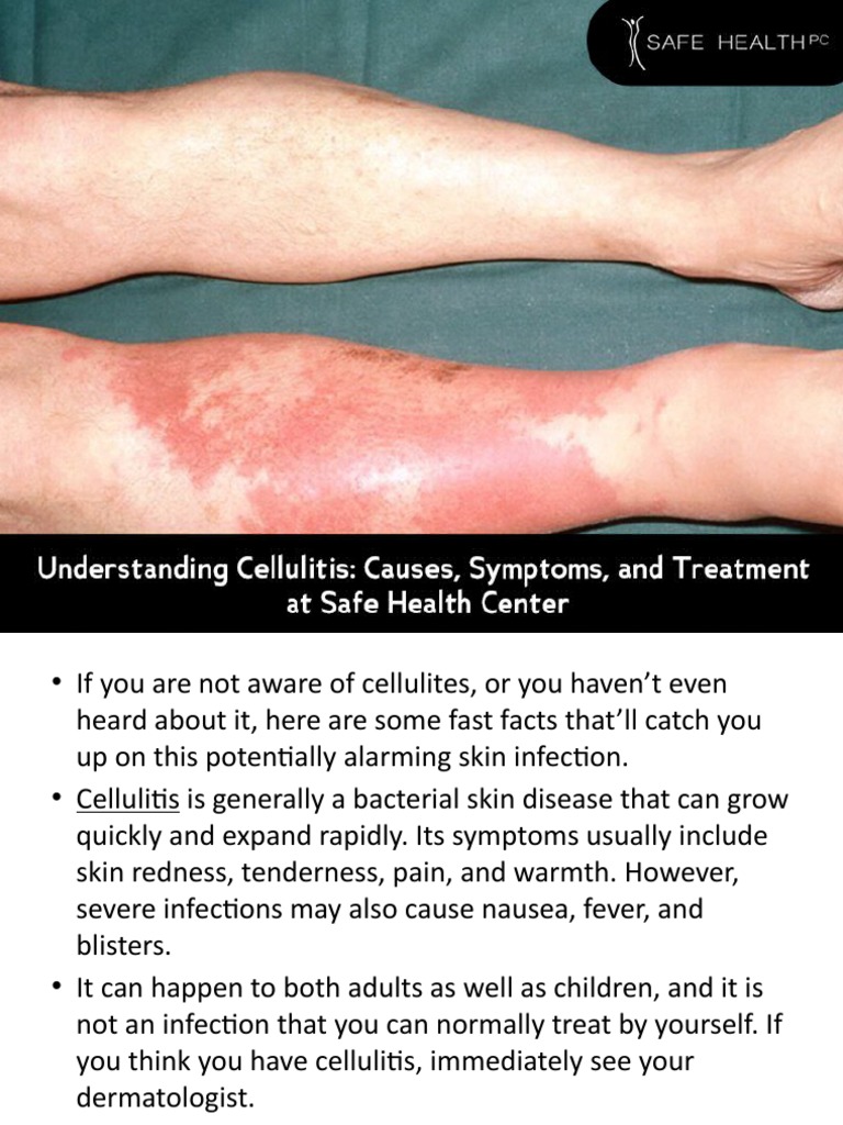 Cellulitis Causes, Symptoms and Treatment at Safe Health Center in MT Pleasant, MI | PDF | Wound ...