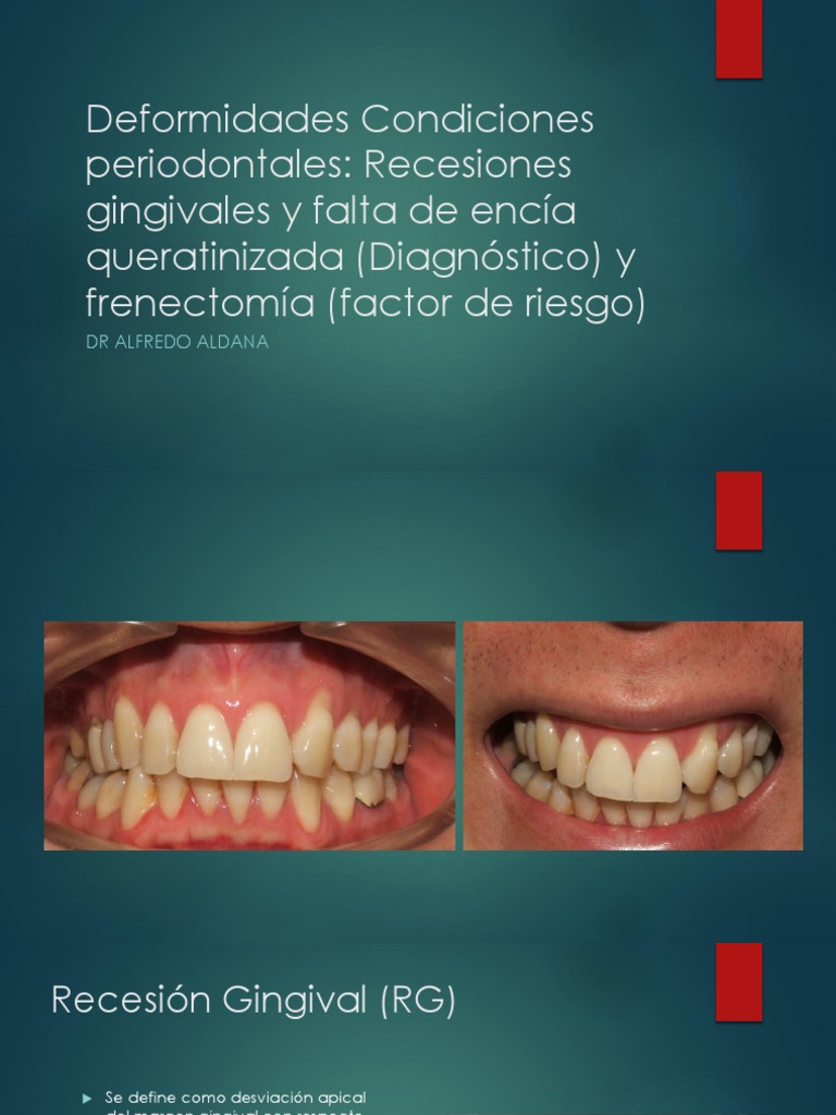 recesión gingival.pdf | PDF | Periodoncia | Ramas de Odontología