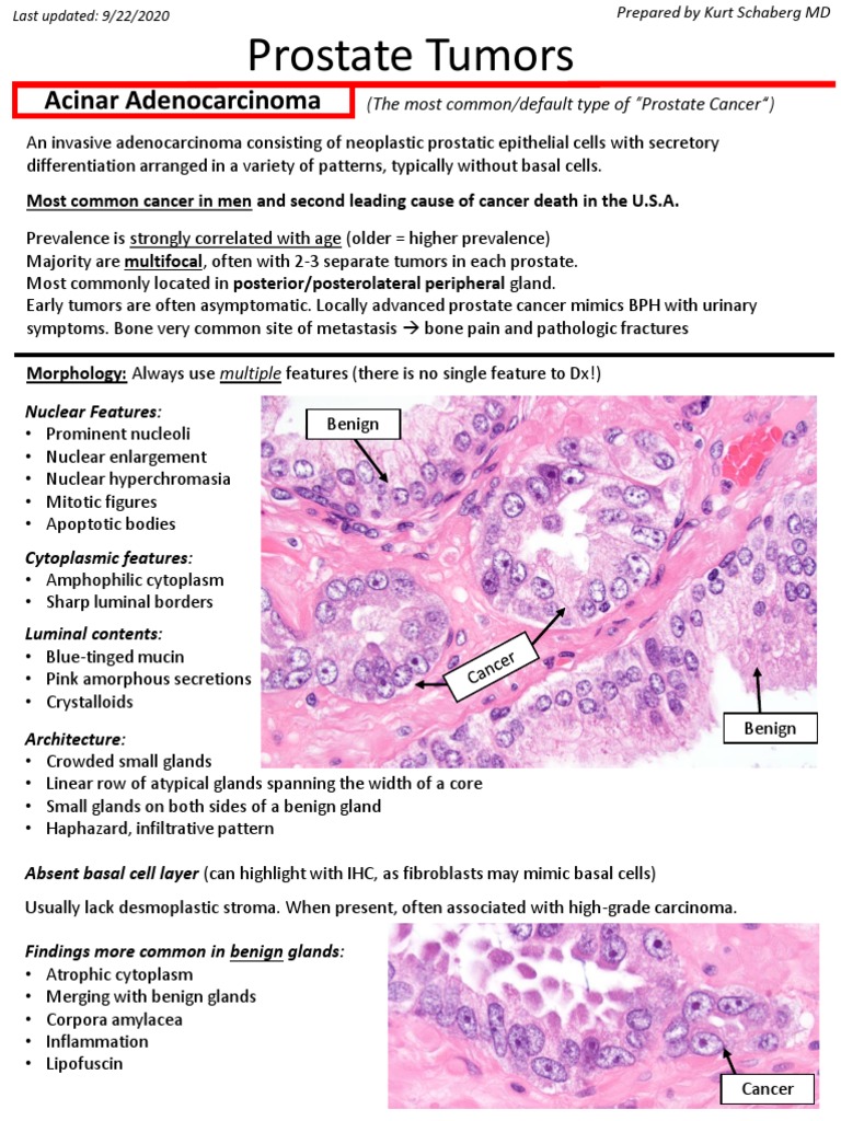 Prostate Tumors | PDF | Prostate Cancer | Adenocarcinoma