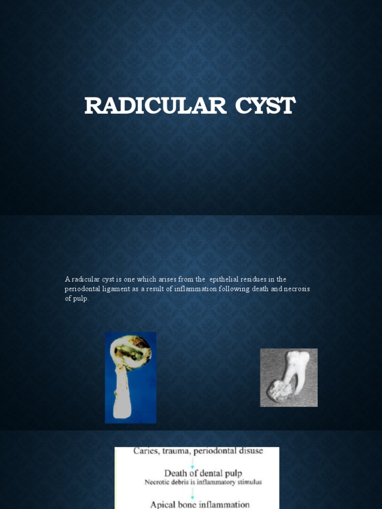 Radicular Cyst | PDF | Clinical Medicine | Diseases And Disorders