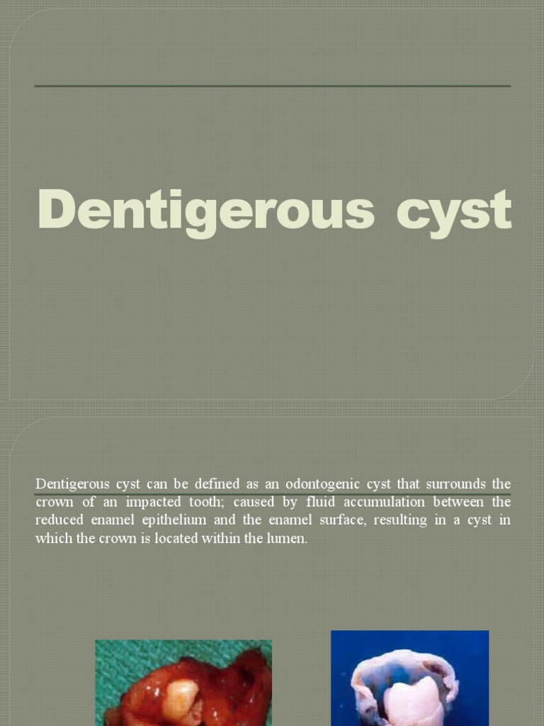 Overview of Dentigerous Cysts | PDF | Epithelium | Diseases And Disorders