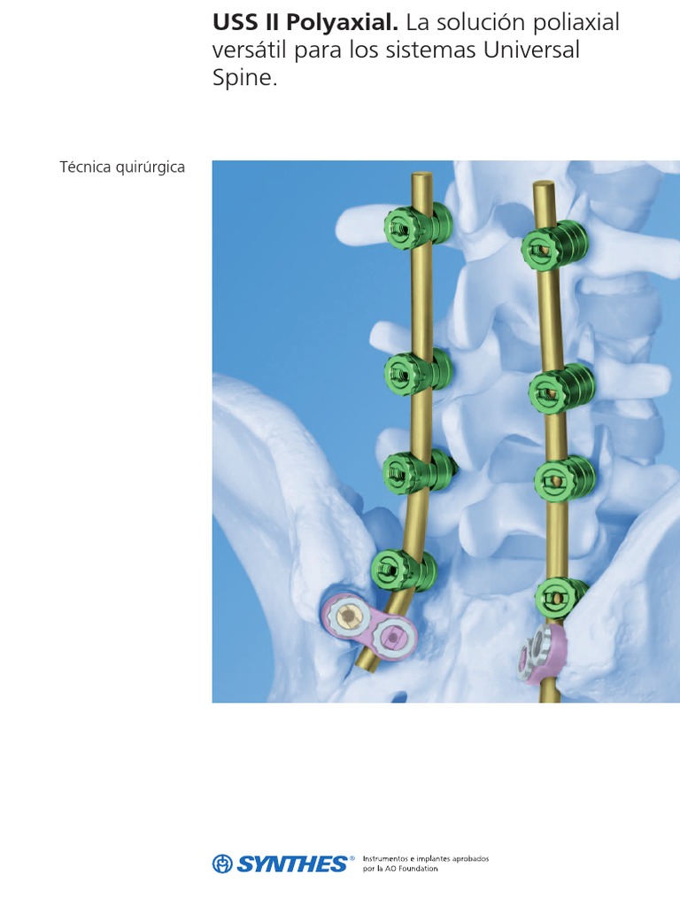 USS II Polyaxial Synthes | PDF | Tornillo