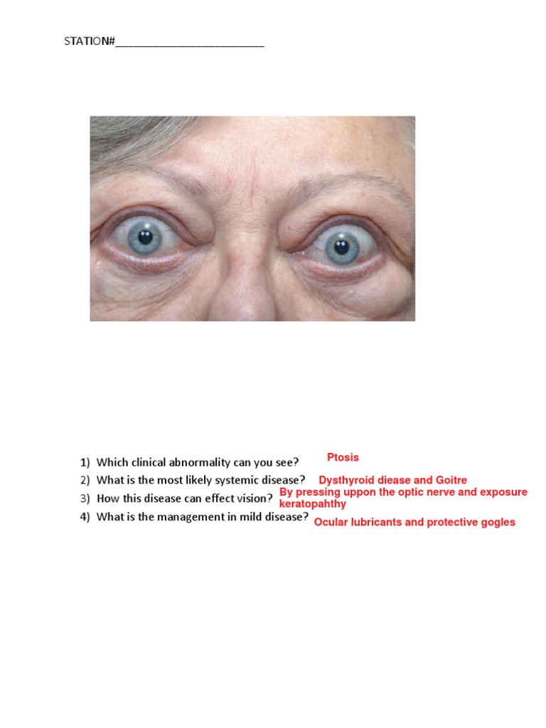 Ophthalmology Ospe | PDF | Glaucoma | Medicine