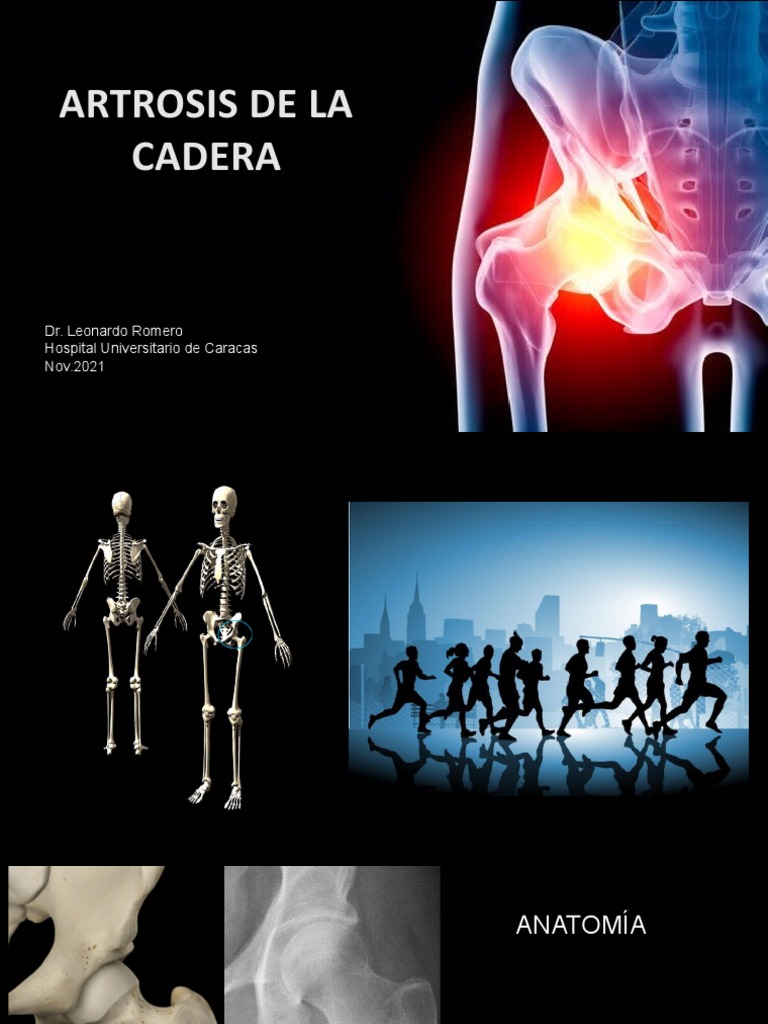 Artrosis de La Cadera | PDF | Articulación | Osteoartritis