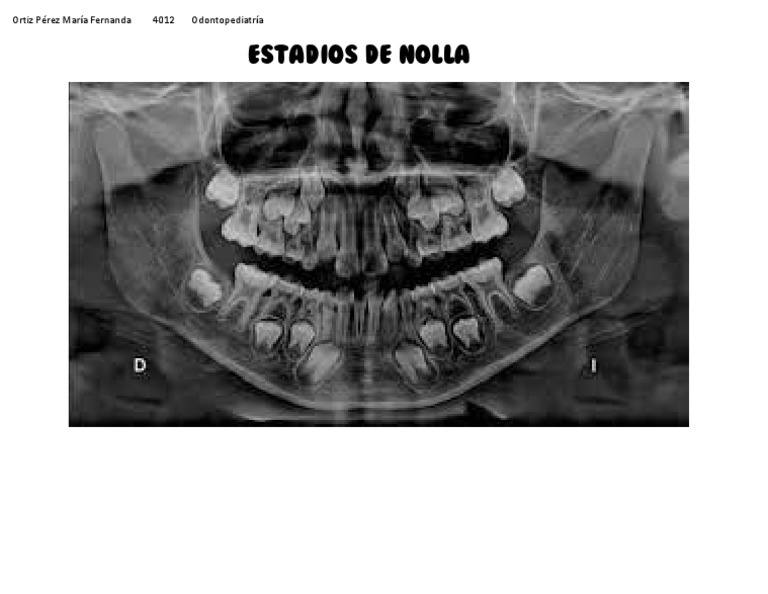 Estadios De Nolla Developmental Stages In Demirjian's Method(10)