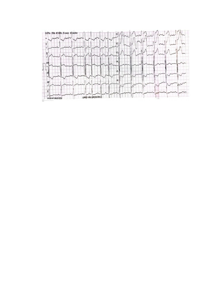 Contoh Ekg | PDF
