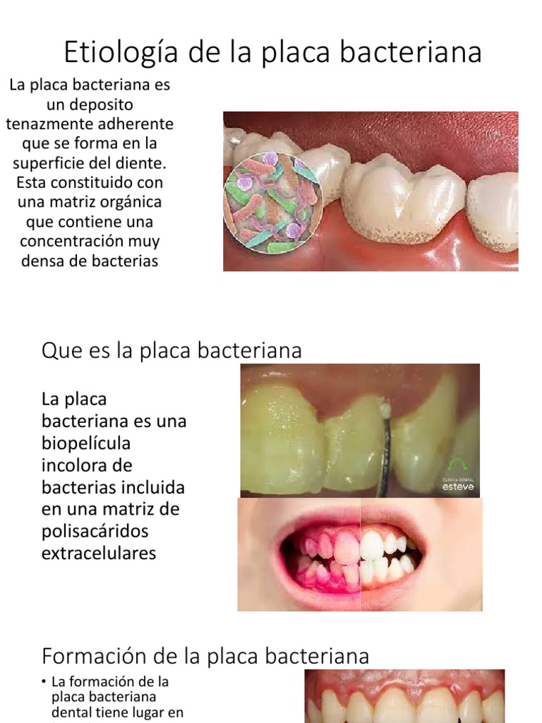 Formación y Efectos de la Placa Bacteriana | PDF