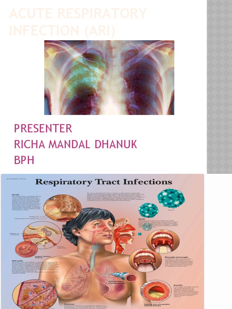 ACUTE RESPIRATORY INFECTION (Ari) | PDF