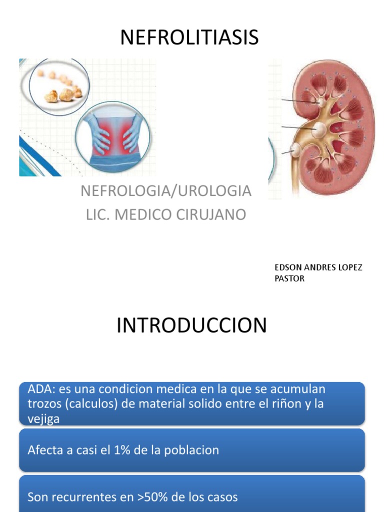 NEFROLITIASIS | PDF | Calcio | Enfermedades y trastornos