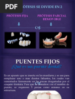 Efecto Ferula en Protesis Fija | PDF | Dentadura postiza | Boca