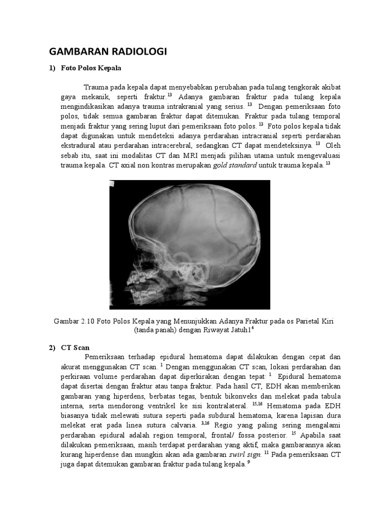 Gambaran CT Scan Epidural Hematoma | PDF