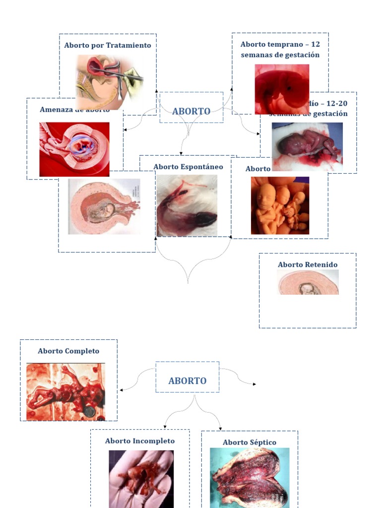 Tipos de Abortos | PDF