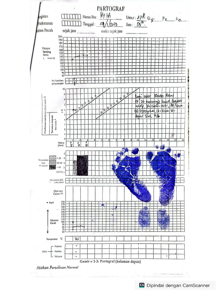 Contoh Partograf PDF | PDF
