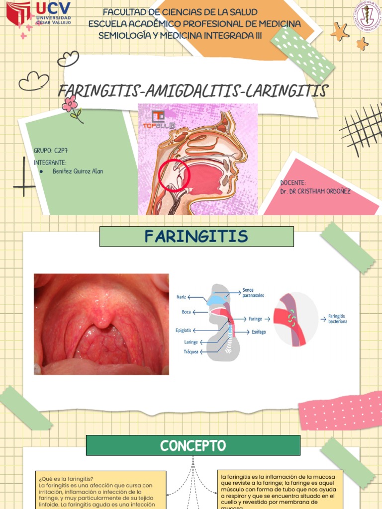 Faringitis Amigdalitis Laringitis | PDF | Virus | Herpes Simple