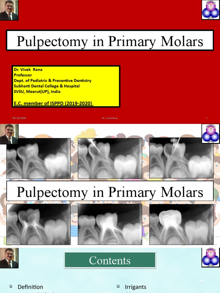 Pulpectomy Techniques for Primary Molars | PDF | Dentistry | Health ...