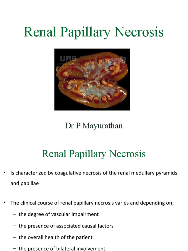 Renal Papillary Necrosis | PDF | Multiple Myeloma | Kidney