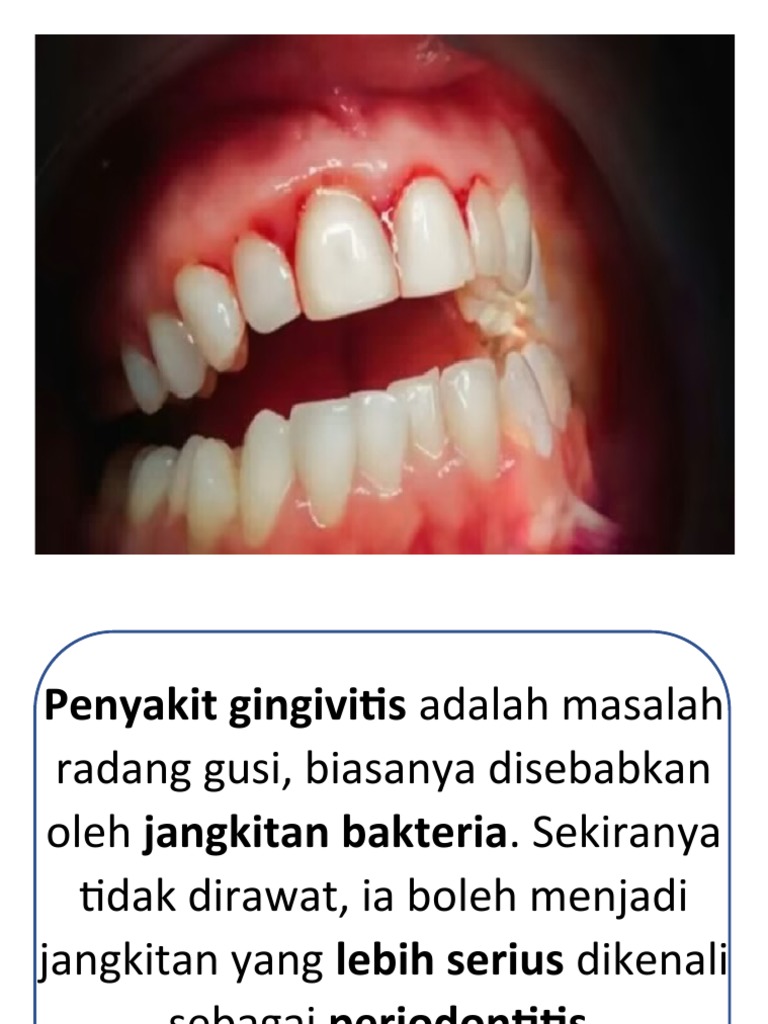 Penyakit Gusi Gingivitis | PDF