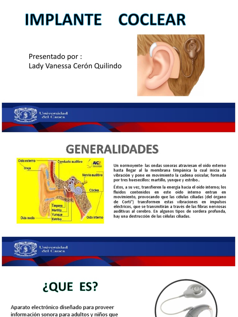 Implante Coclear | PDF | Escuchando | Especialidades Medicas