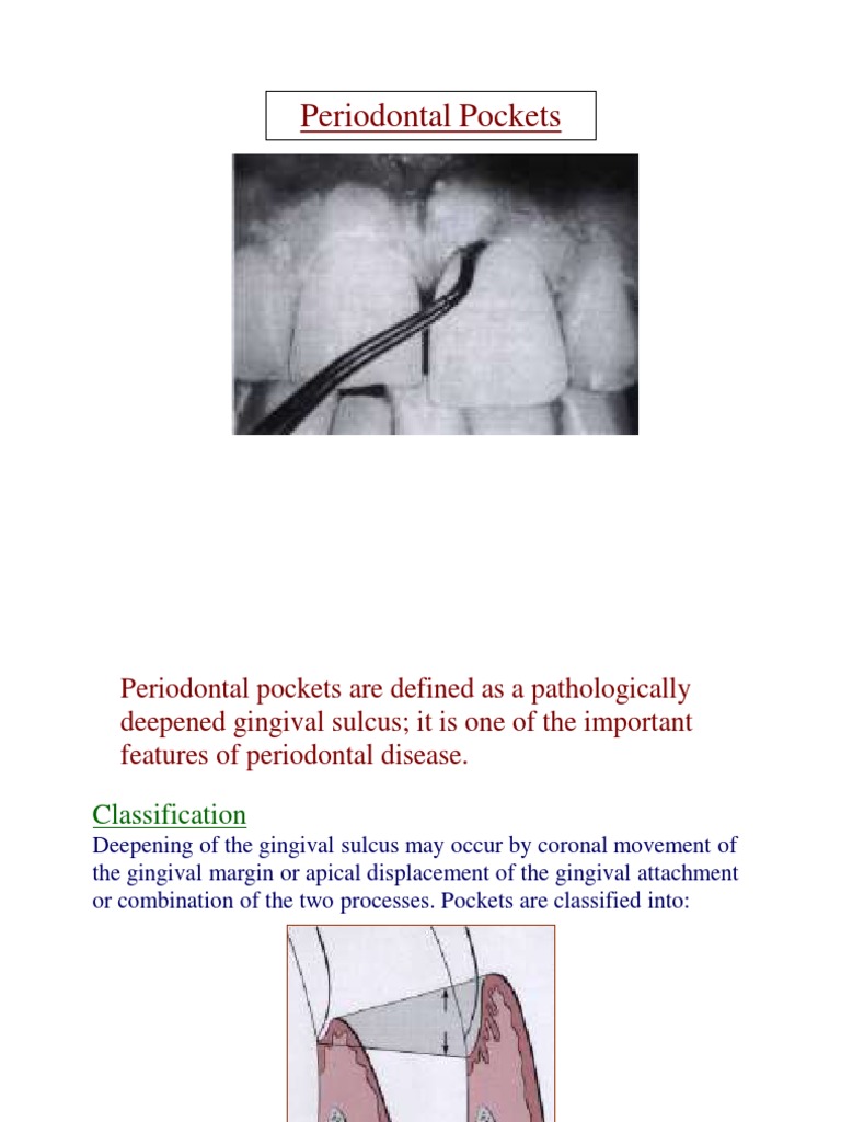 Periodontal Pockets | PDF | Periodontology | Dentistry