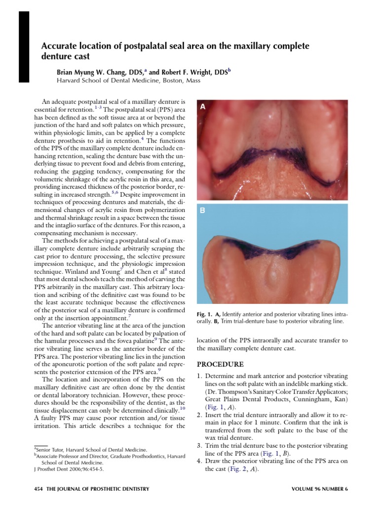 Accurate location of postpalatal seal area on the maxillary complete ...