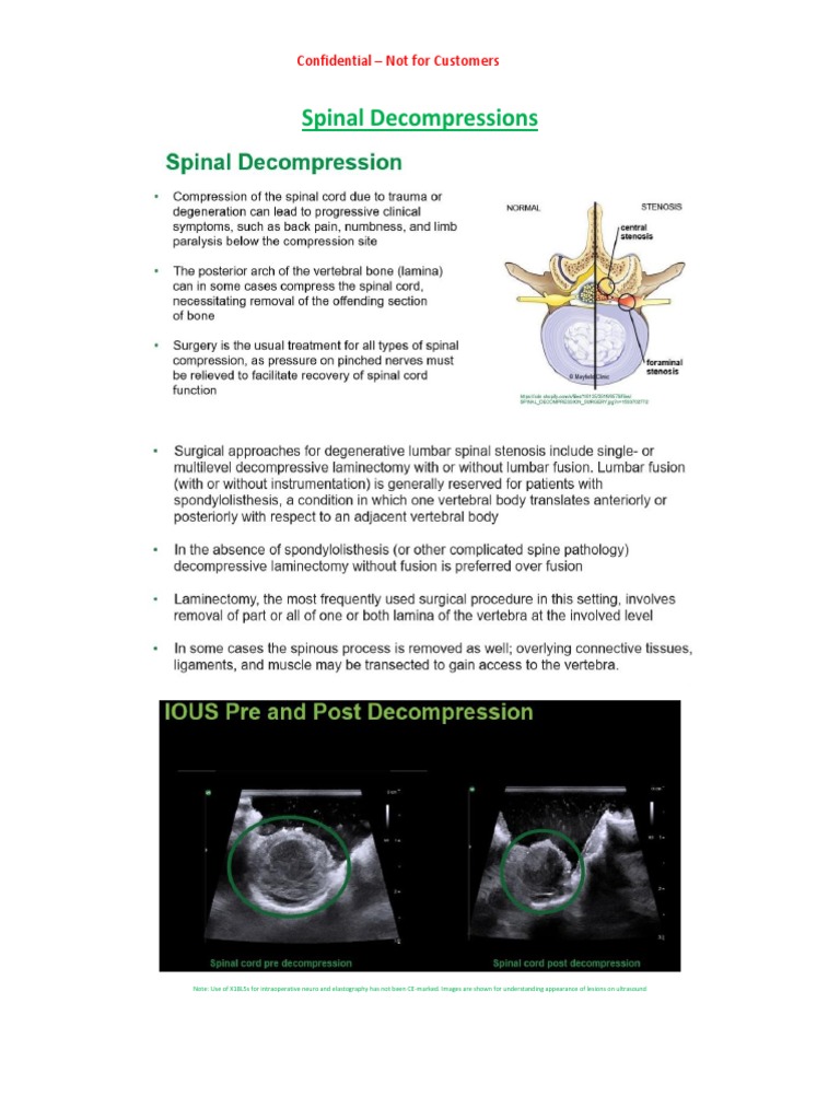 Spinal Decompressions_Procedure Handout_EU | PDF