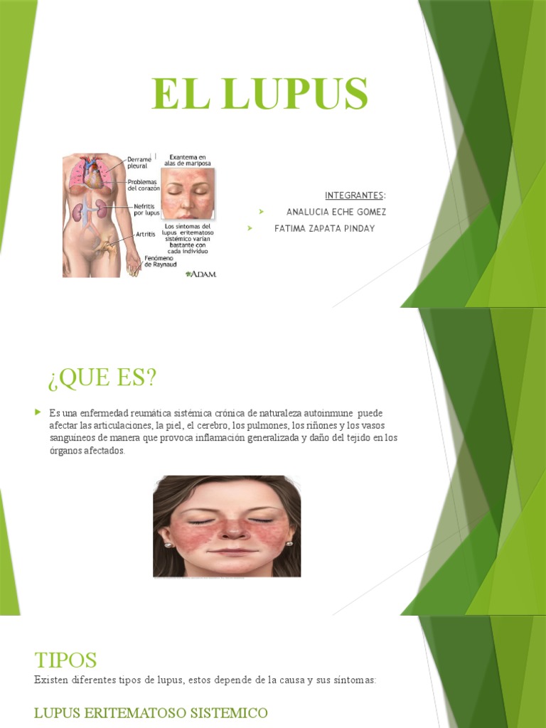 Tipos y Tratamientos del Lupus | PDF | Inflamación | Enfermedades y ...