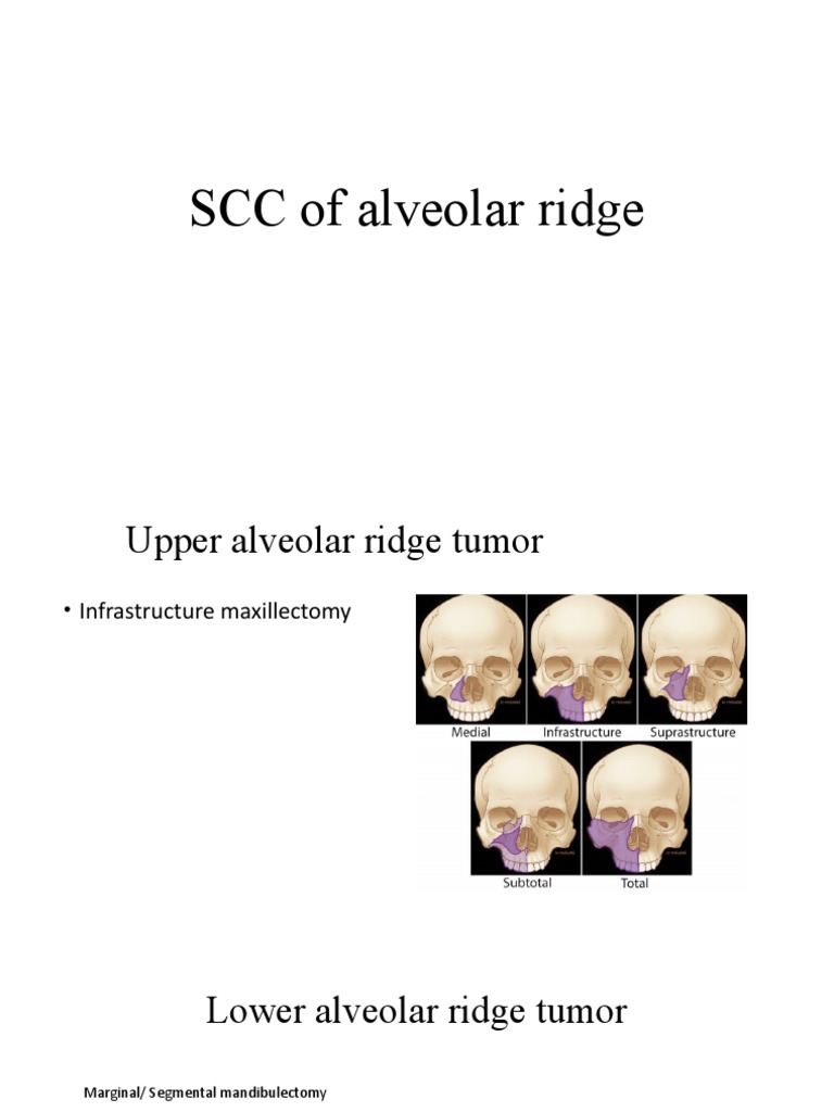 SCC of Alveolar Ridge | PDF