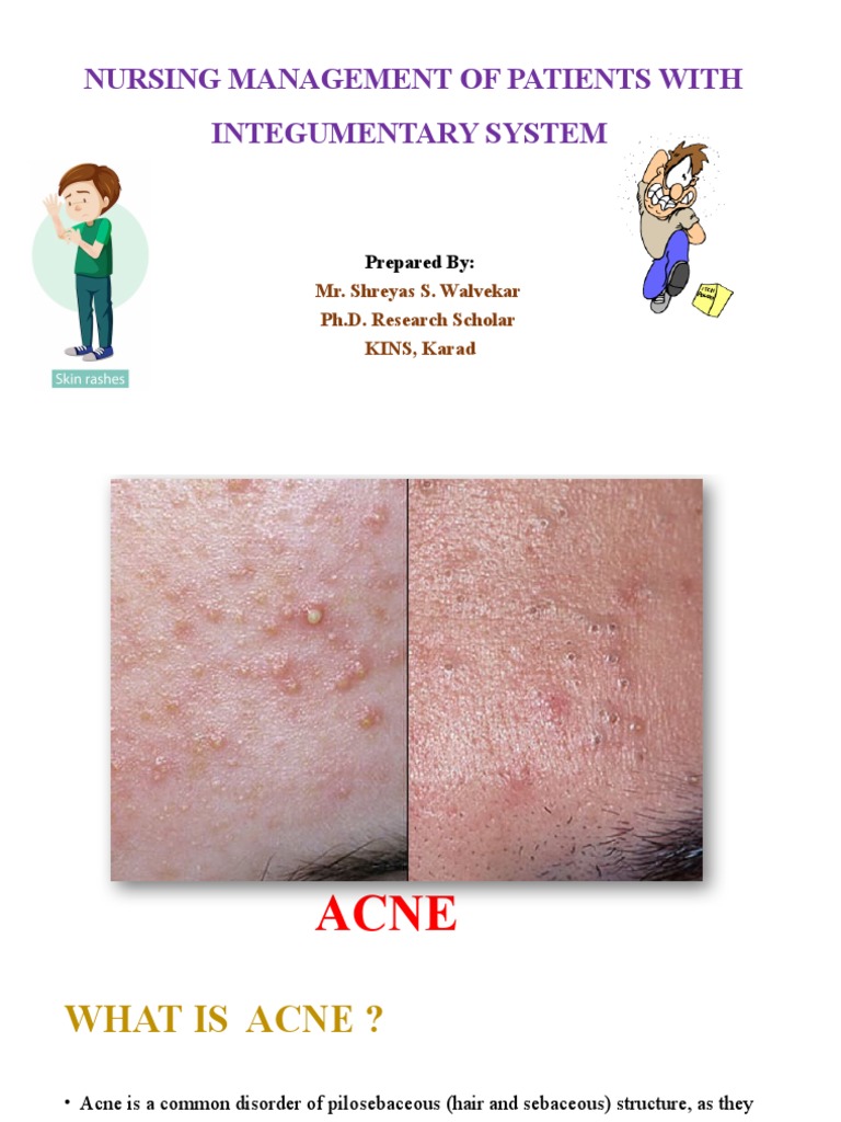 ACNE | PDF | Integumentary System | Skin
