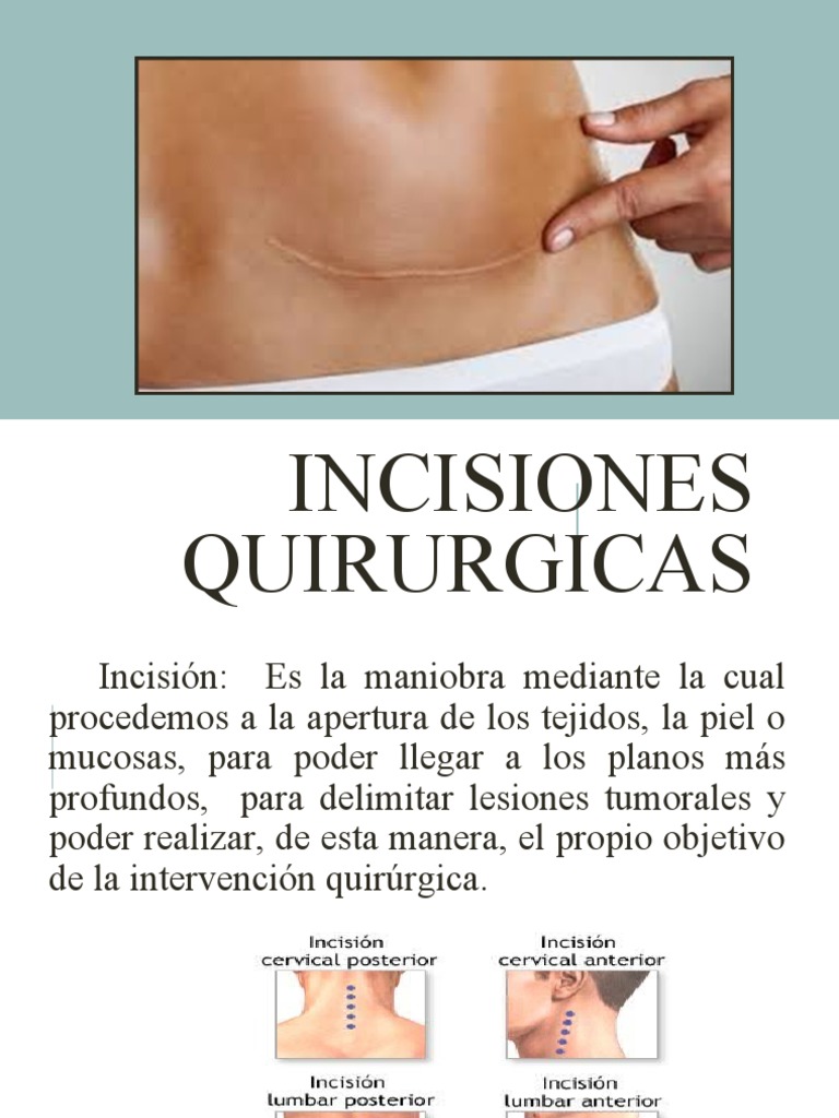 Incisiones Quirurgicas | PDF