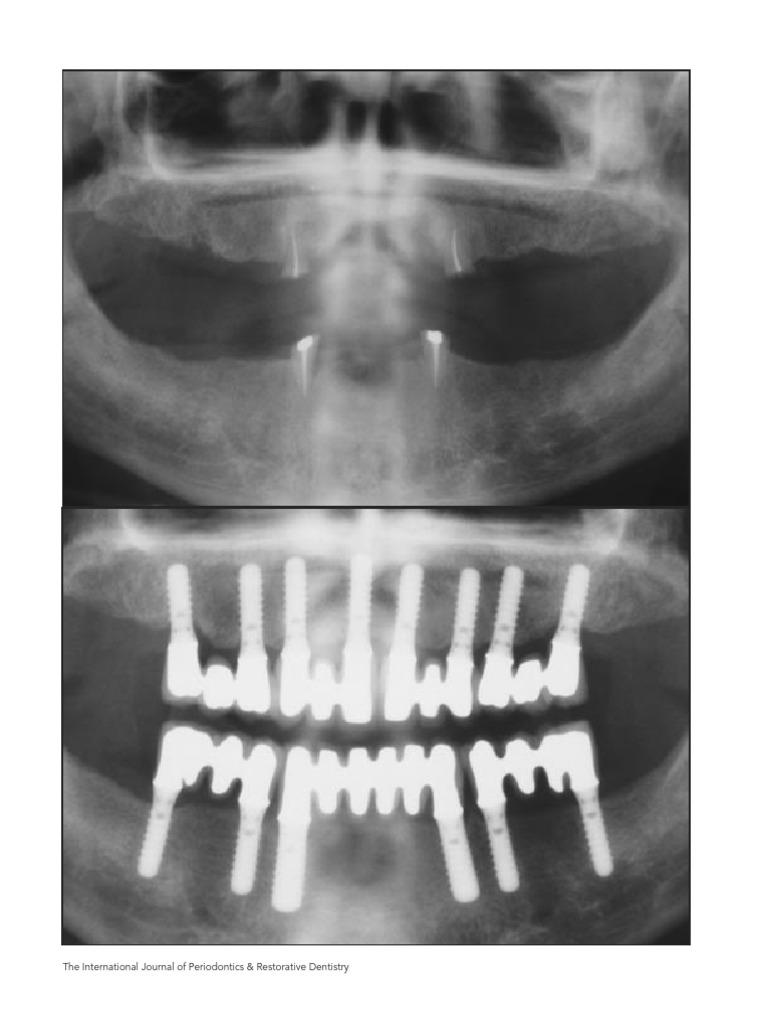 Gallucci 1 | PDF | Dental Implant | Health Care