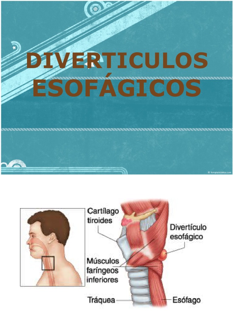 Copia de DIVERTICULOS ESOFÁGICOS | PDF | Esófago | Gastroenterología